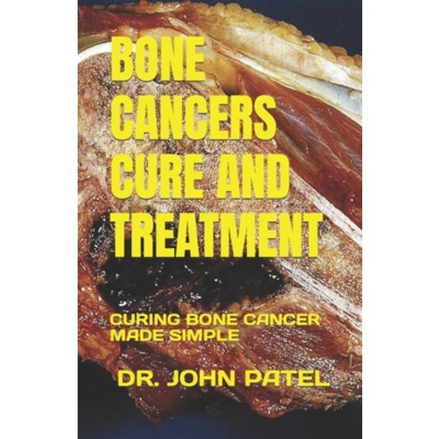 (영문도서) Bone Cancers Cure and Treatment: Curing Bone Cancer Made Simple ...